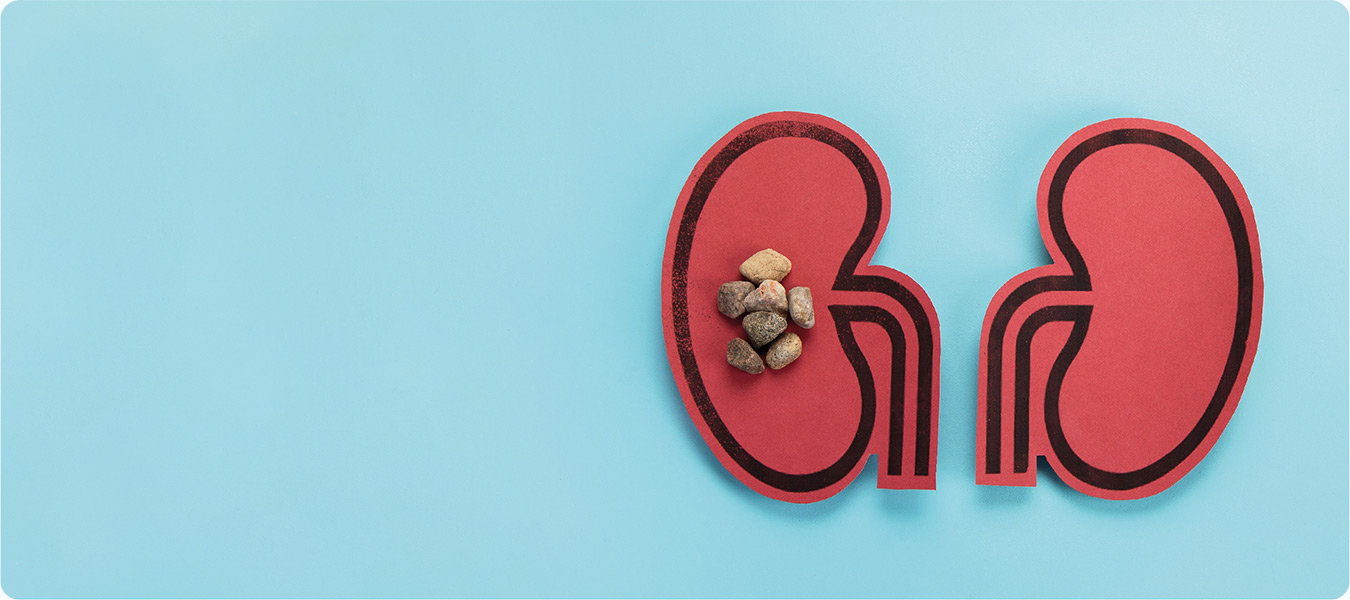 Kidney Stones | Devicare
